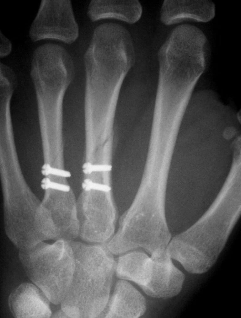 Fracturas de dedos y tipos de cirugía - Advansur Traumatología