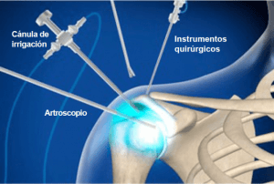 Recuperación tras la rotura del tendón - Advansur Traumatología